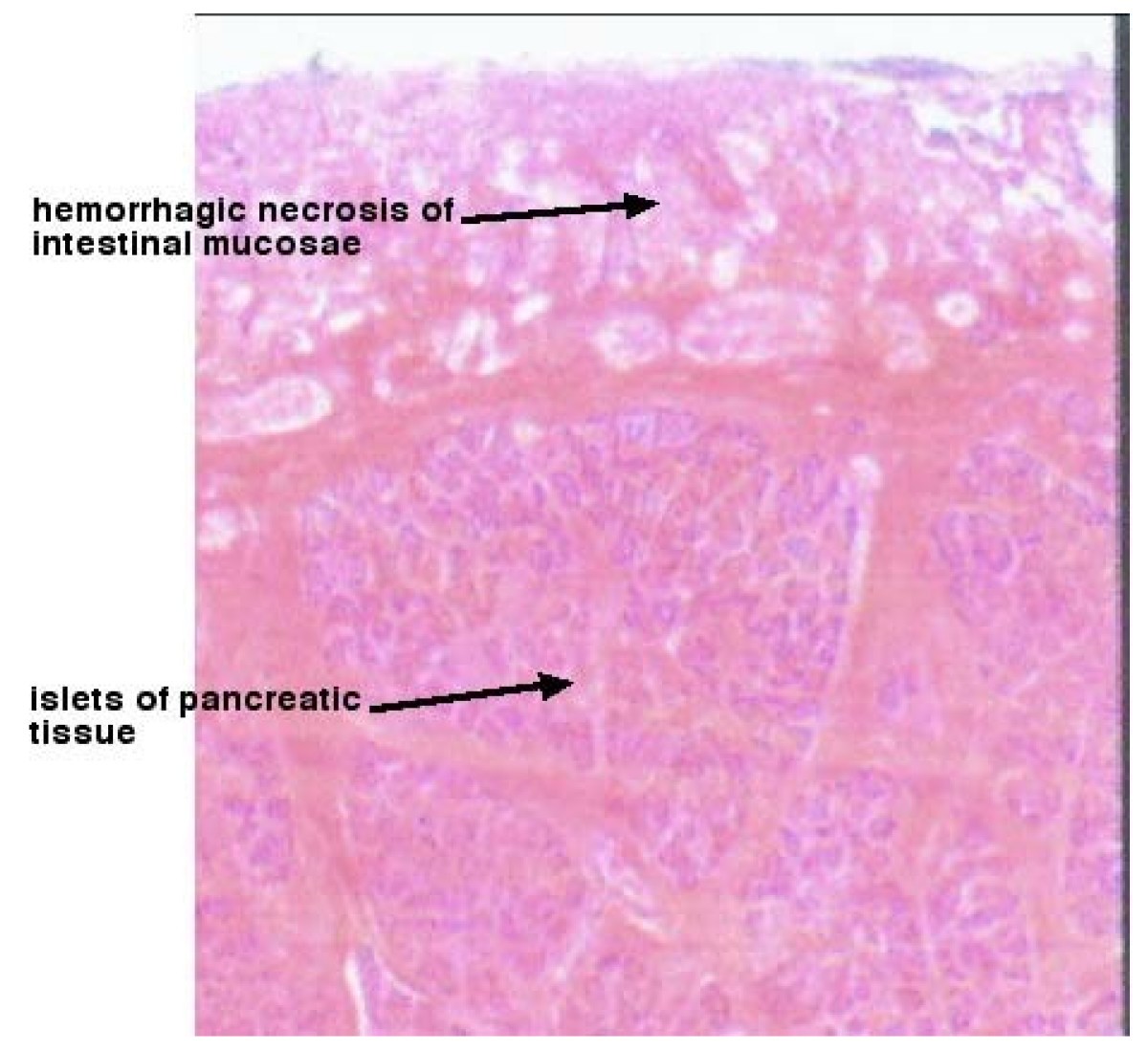 Triple intussusception involving heterotopic pancreatic tissue: a case ...