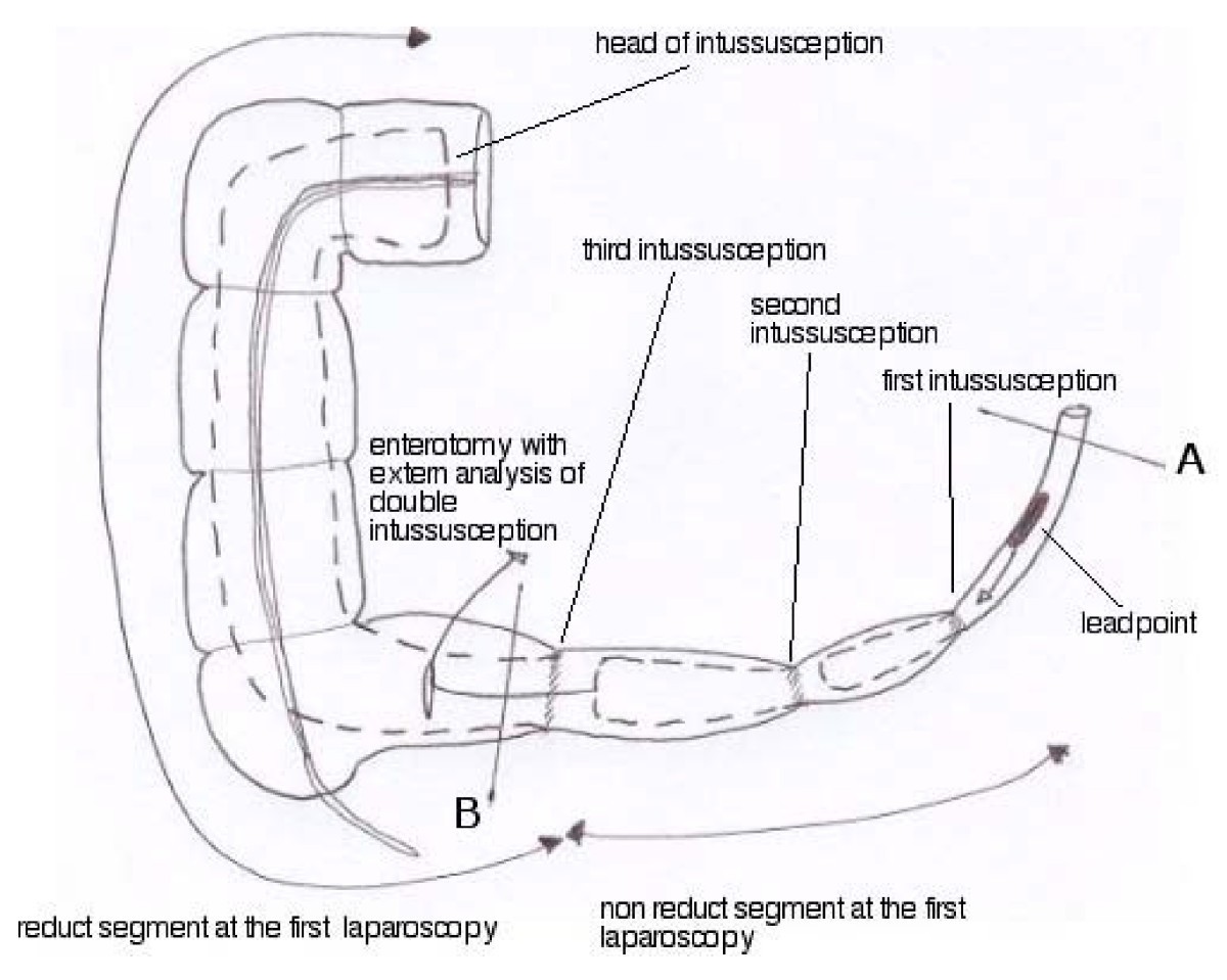 Triple intussusception involving heterotopic pancreatic tissue: a case ...