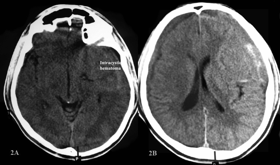 Temporal fossa arachnoid cyst presenting with bilateral subdural ...