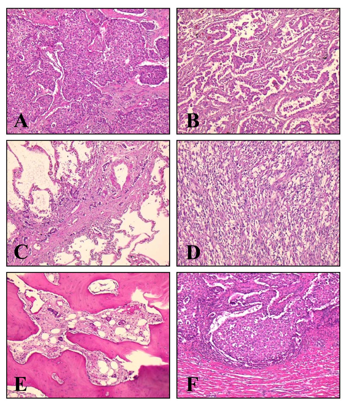 Lung adenocarcinoma with giant cyst formation showing a variety of ...