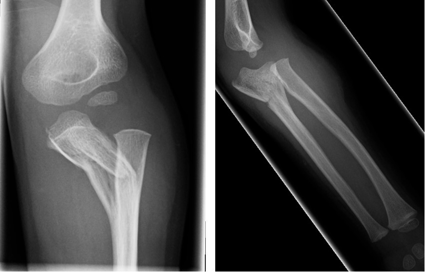 Use of intra-medullary stacked nailing in the reduction of proximal ...