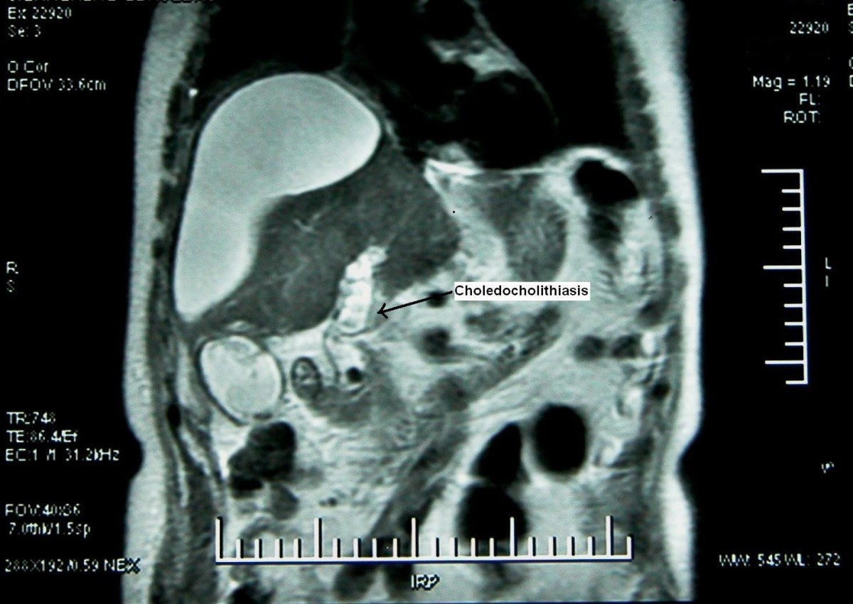 Spontaneous biloma managed with endoscopic retrograde ...