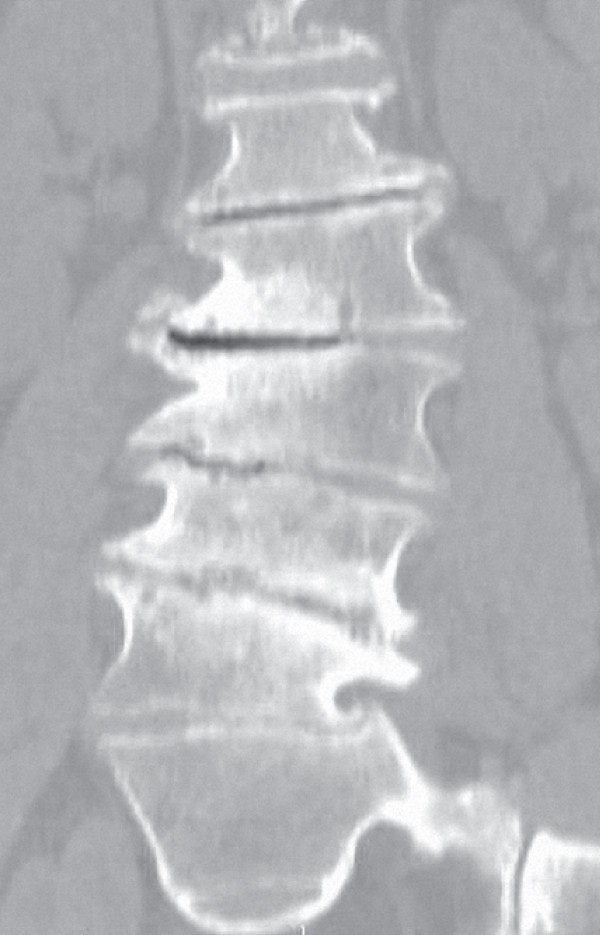 Vertebrae Disc Collapse at Marilyn Hudgins blog