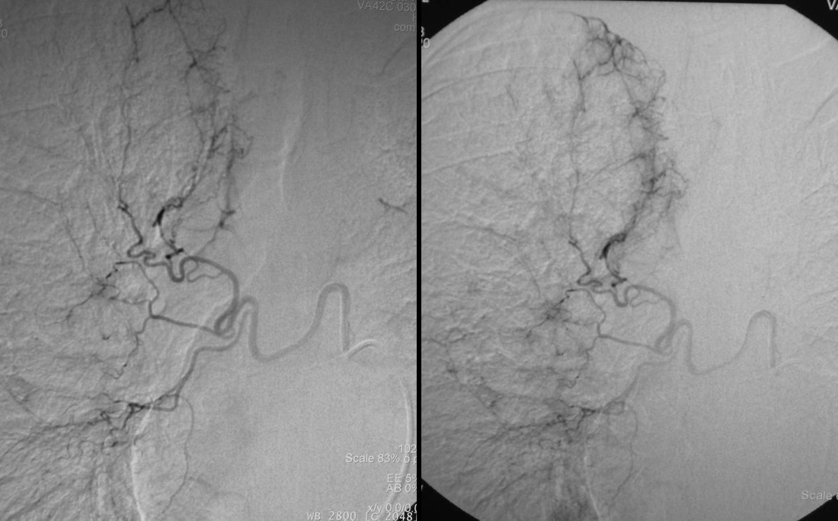 Bronchial artery embolization for management of massive cryptogenic ...
