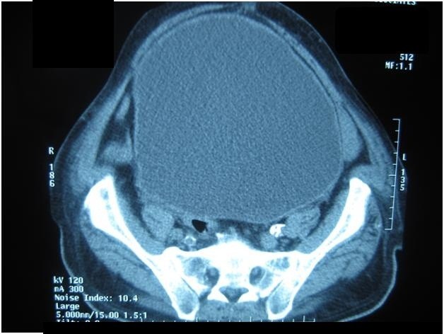 Distended bladder presenting with constipation and venous obstruction ...