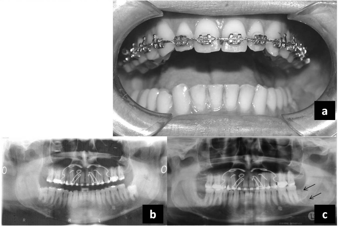 Pathological (late) fractures of the mandibular angle after lower third ...