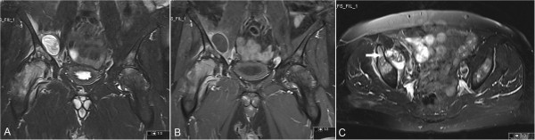 An atypically located large subchondral cyst in an osteoarthritic hip ...