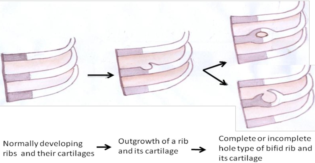 Additional circular intercostal space created by bifurcation of the ...
