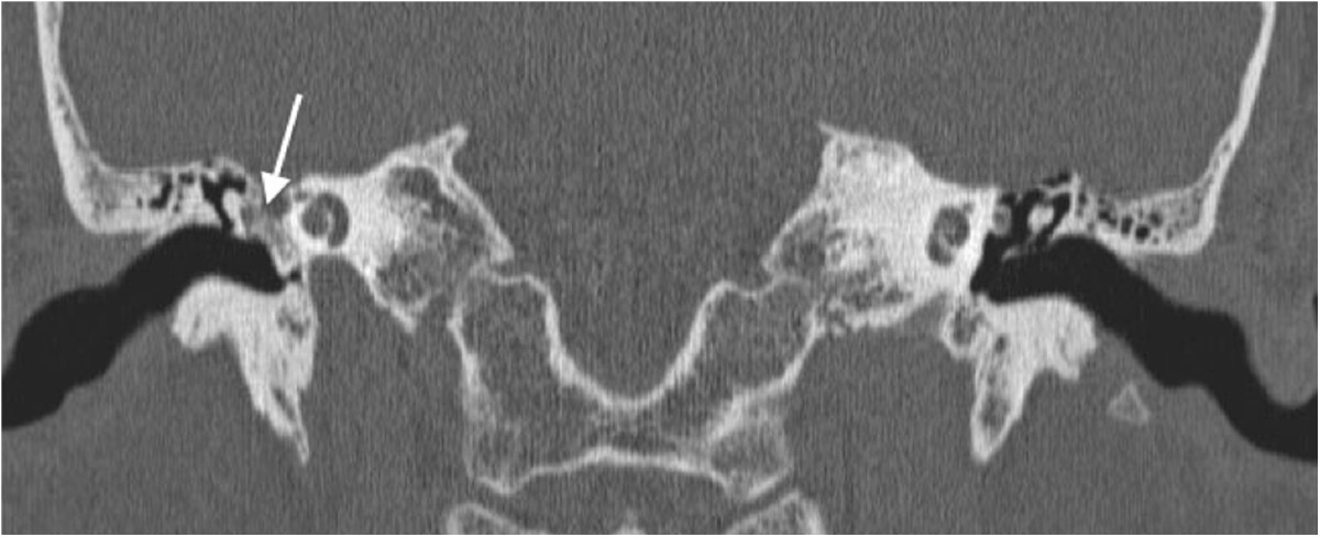 Middle ear osteoma causing progressive facial nerve weakness: a case ...