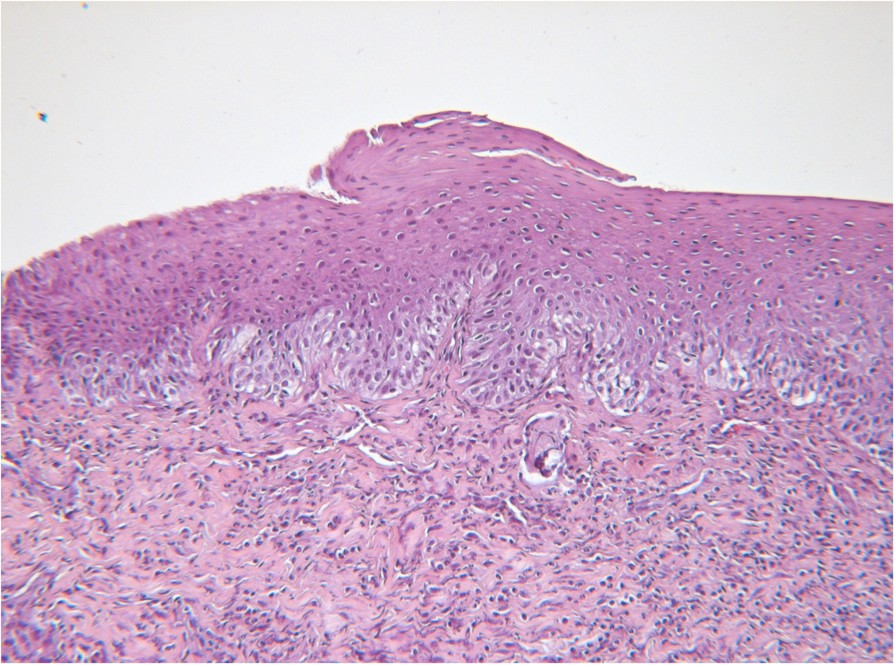 Unusual symptomatic inclusion cysts in a newborn: a case report ...