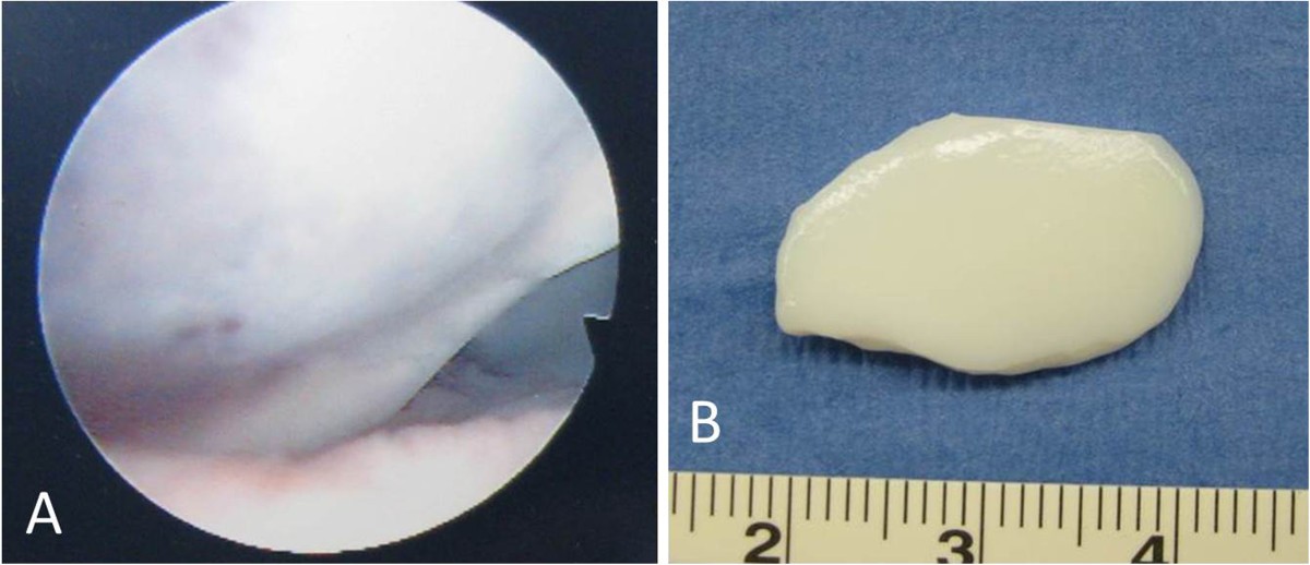 Bone peg fixation of a large chondral fragment in the weight-bearing ...