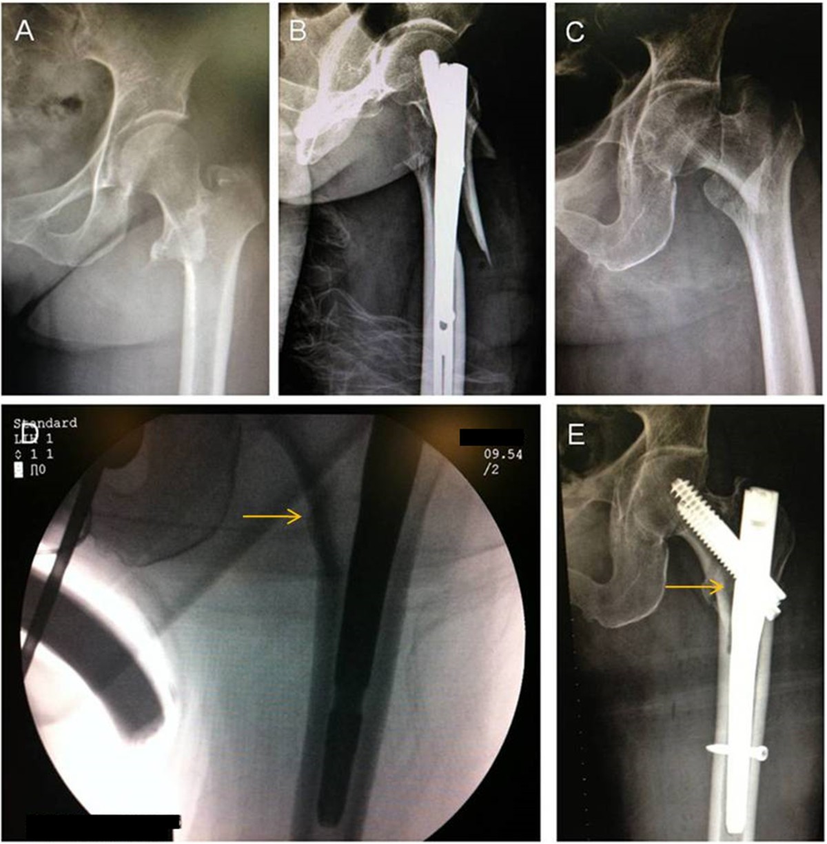 Implantation of INTERTAN™ nail in four patients with intertrochanteric ...
