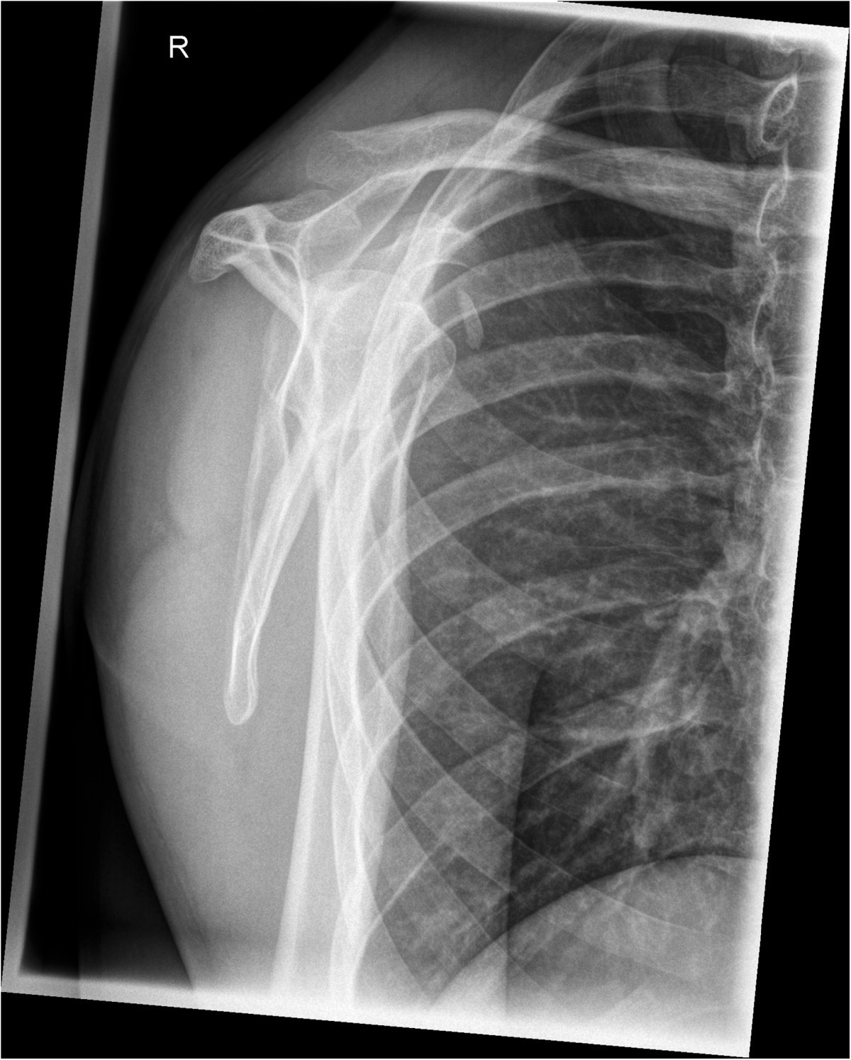 Avulsion fracture of the coracoid process in a patient with chronic ...
