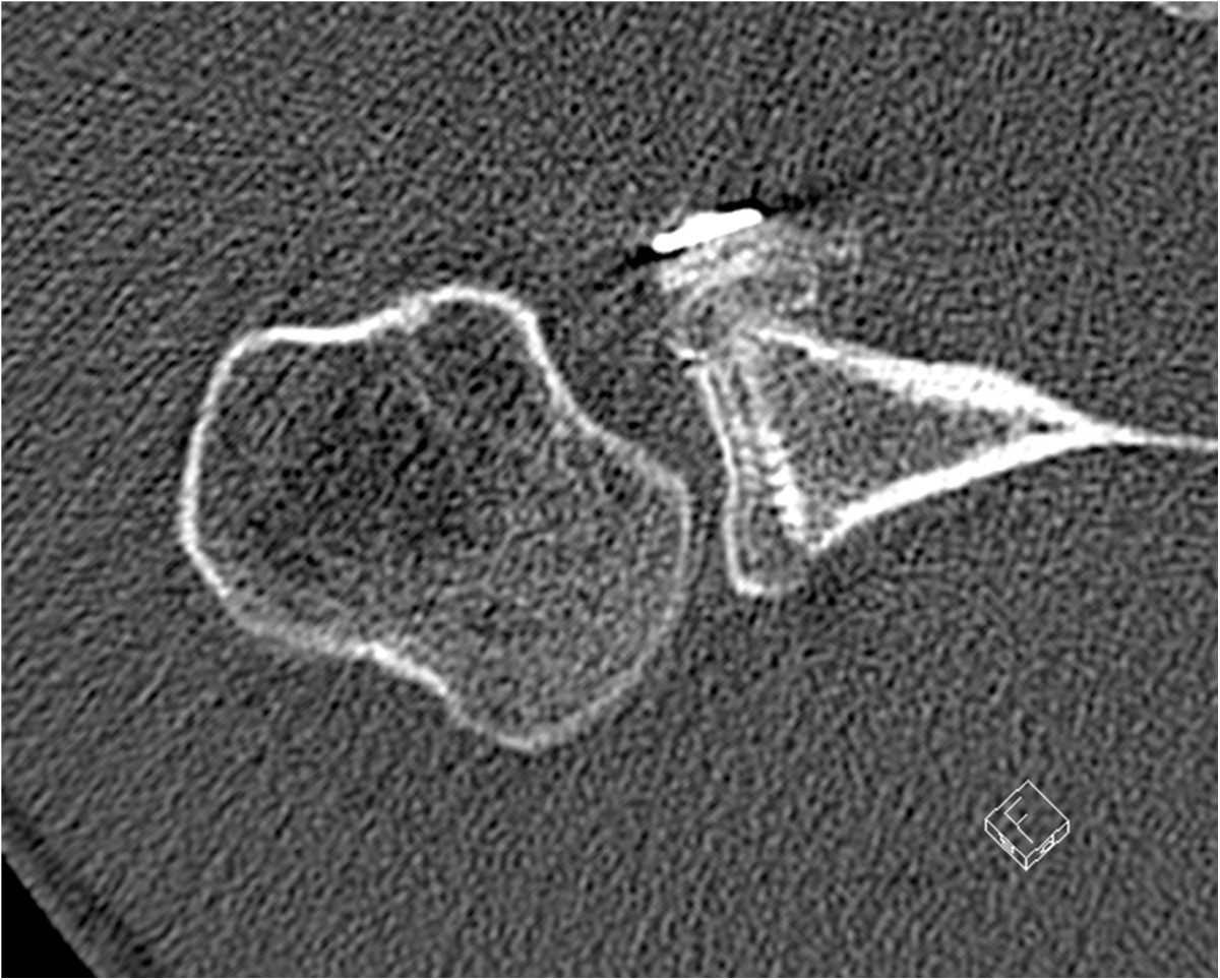 Avulsion fracture of the coracoid process in a patient with chronic ...