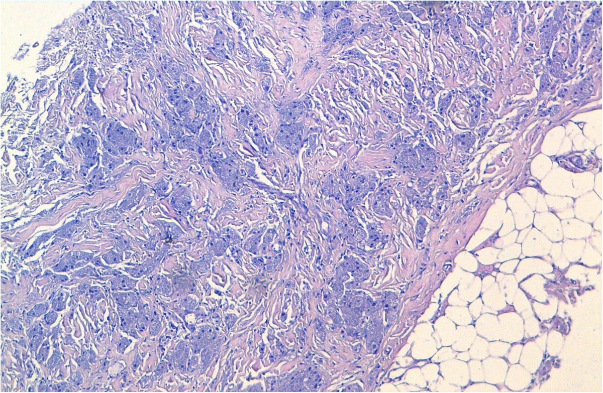 Granular Cell Tumor Of The Breast A Case Report Journal Of Medical