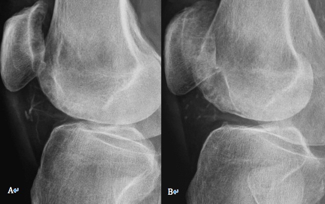 Regression of vascular calcification following an acute episode of ...