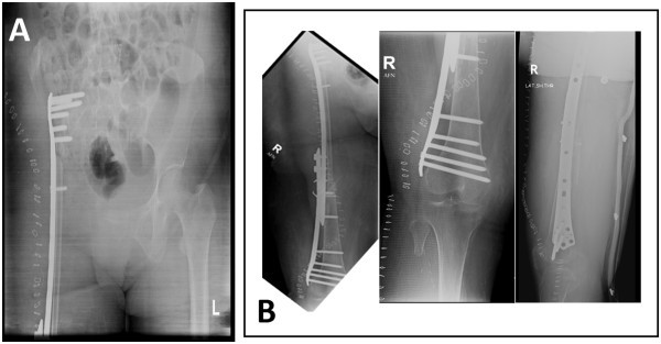 Eradication of advanced pelvic hydatid bone disease after limb salvage ...