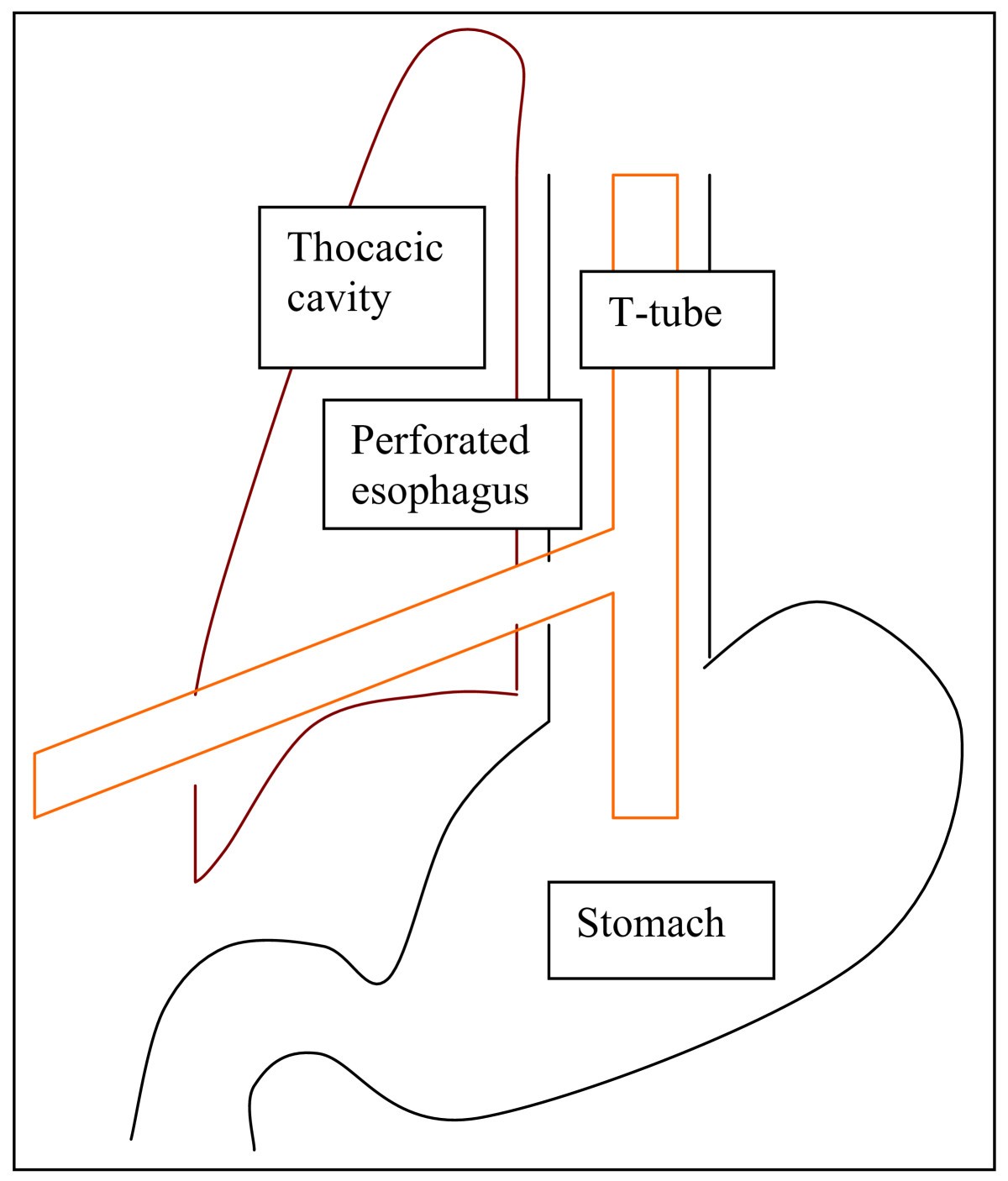 Endoscopic T-tube placement in the management of lye-induced esophageal ...