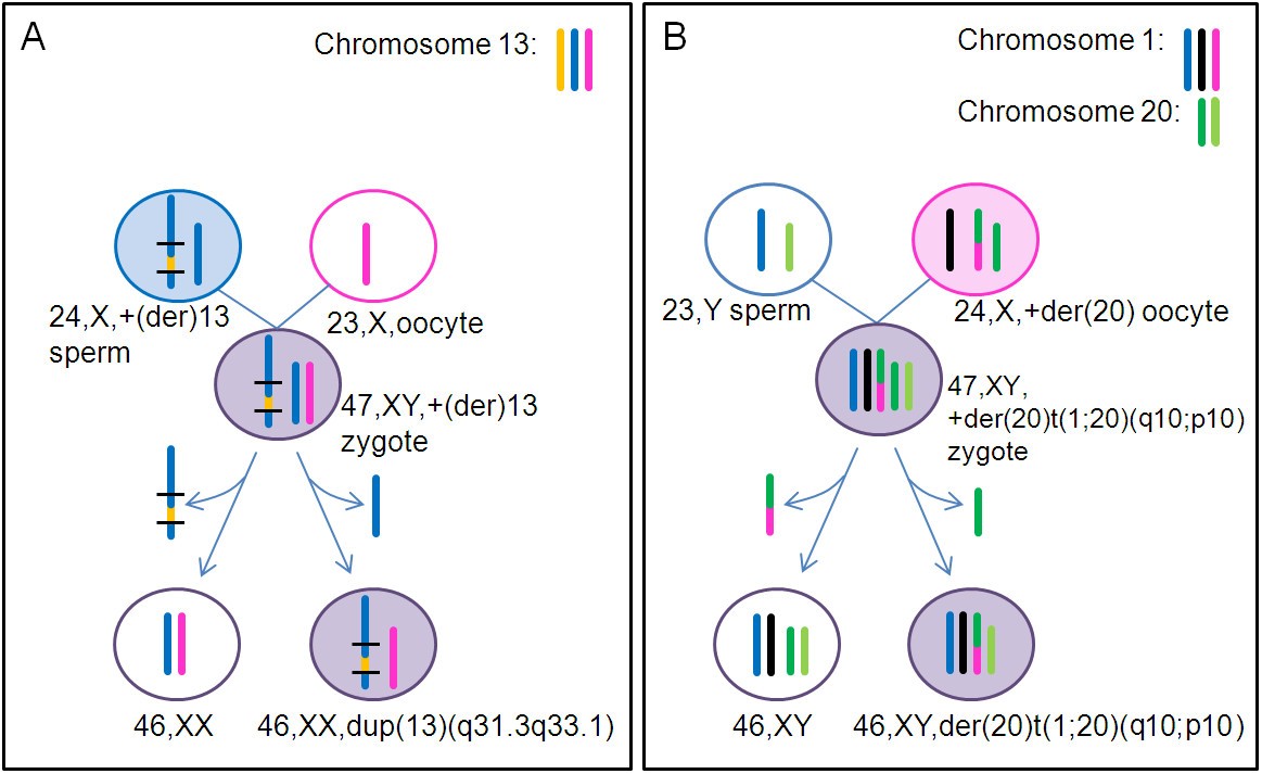 Meiotic errors followed by two parallel postzygotic trisomy rescue ...