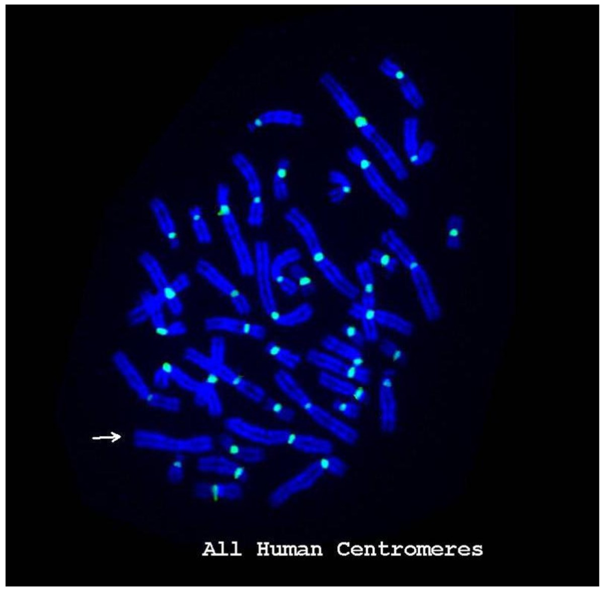 Neocentric X-chromosome in a girl with Turner-like syndrome | Molecular ...