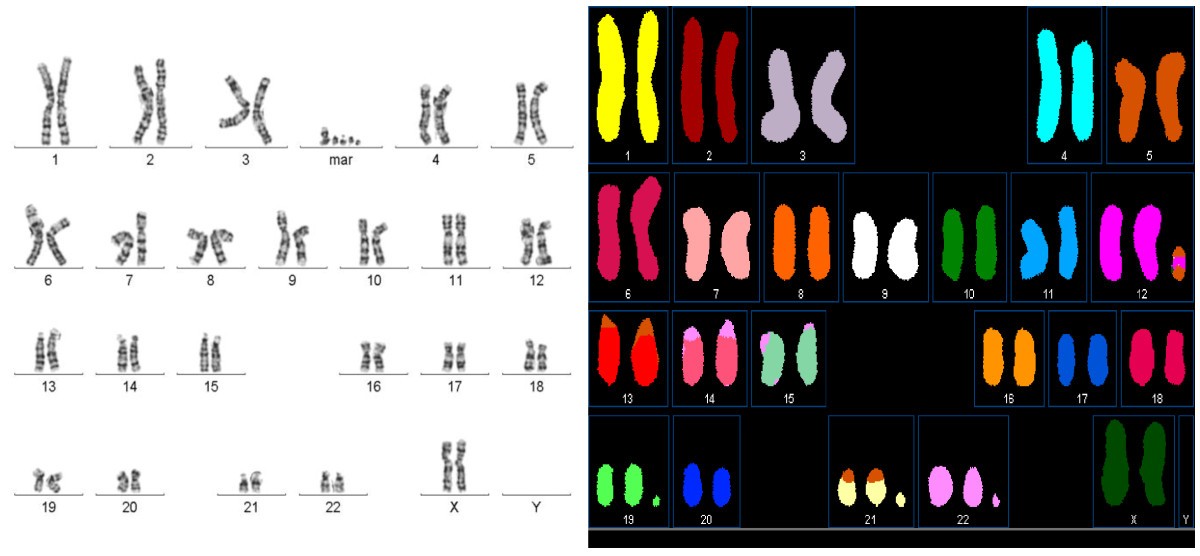 Spectral Karyotyping for identification of constitutional chromosomal ...