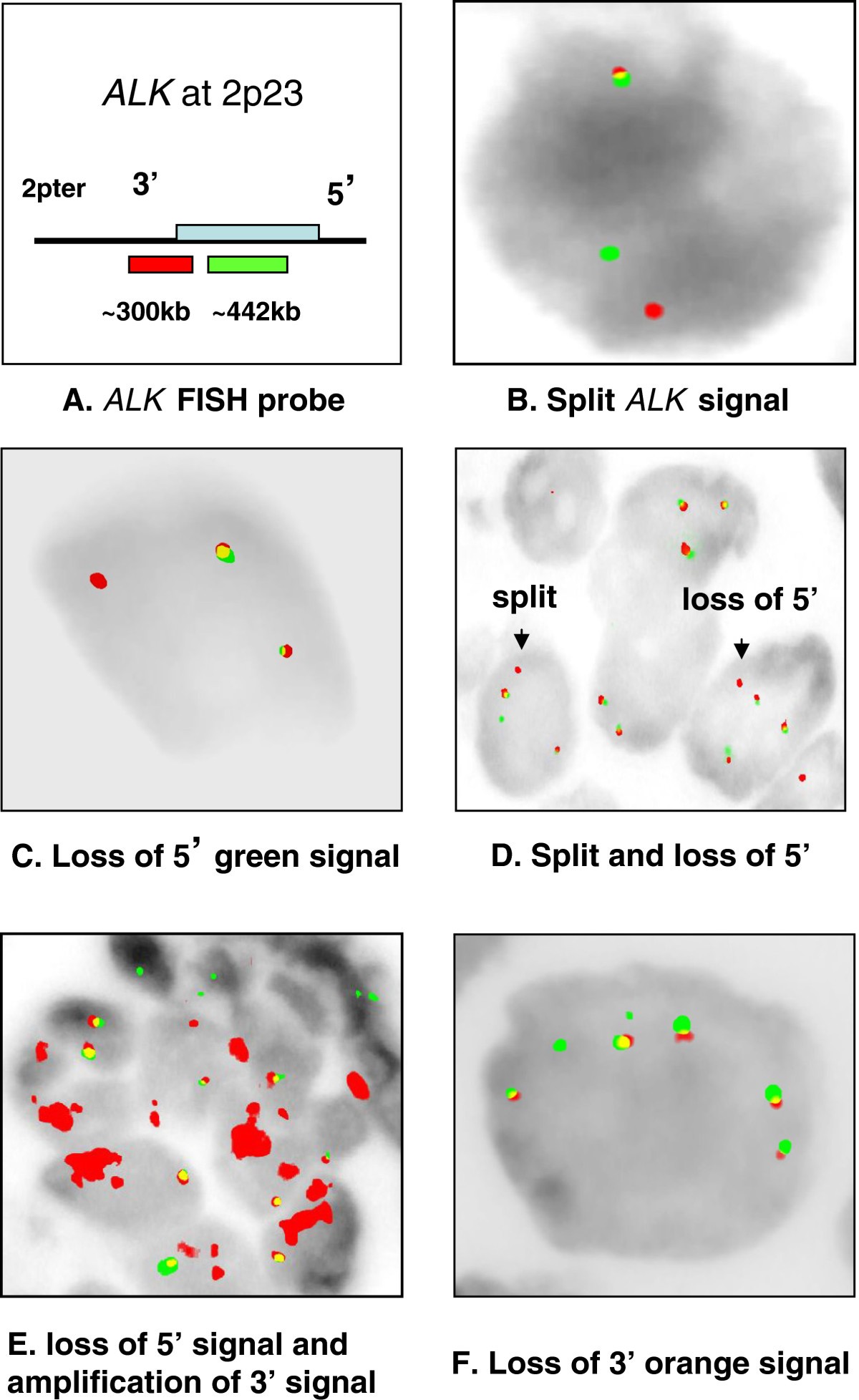 Incidence and patterns of ALK FISH abnormalities seen in a large ...