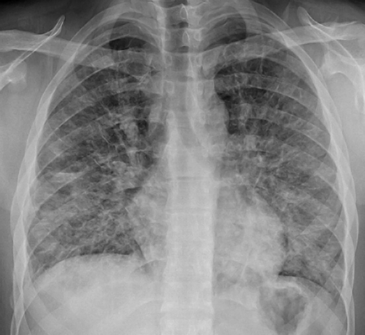 Pulmonary lymphangitic carcinomatosis as a primary manifestation of ...
