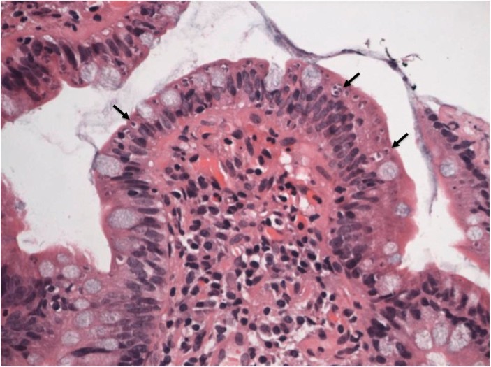 Cyclospora infection in a young woman with human immunodeficiency virus ...