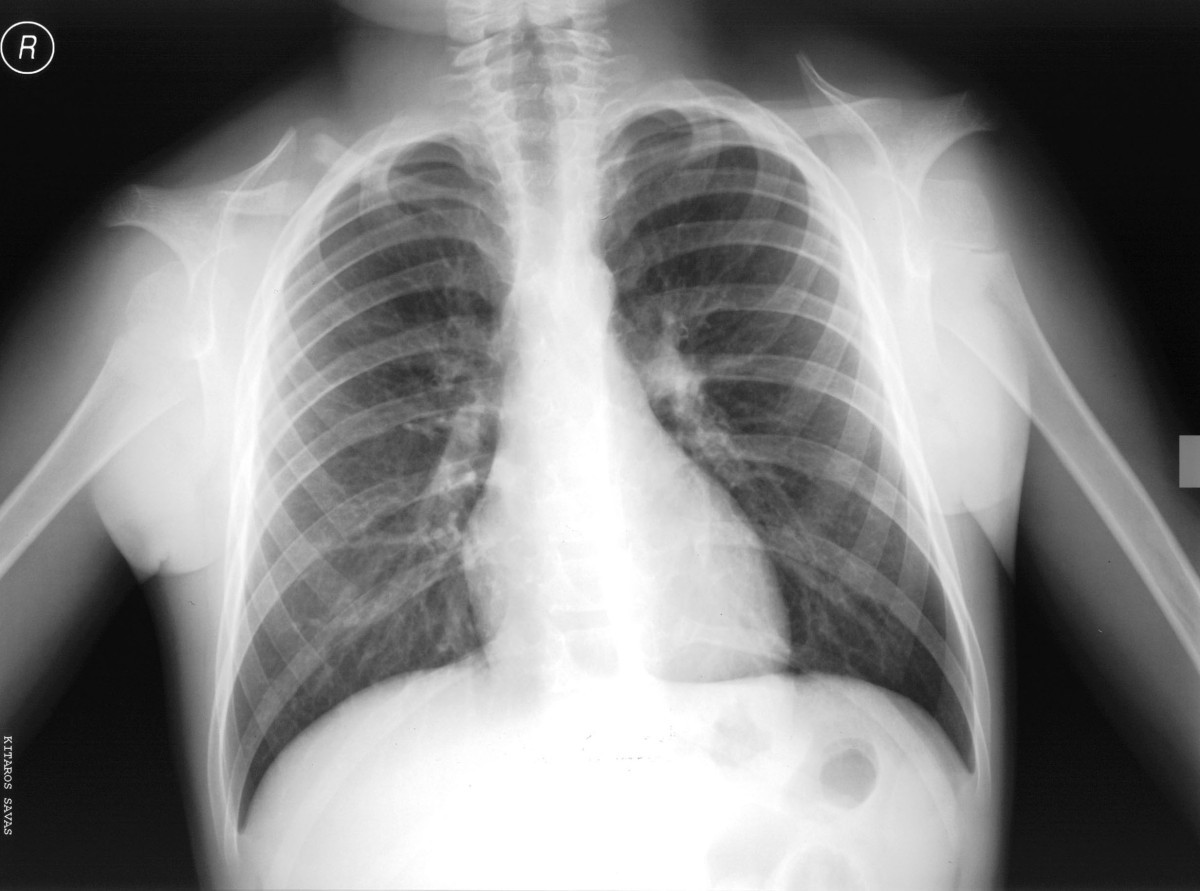 A 13-year-old caucasian boy with cleidocranial dysplasia: a case report ...