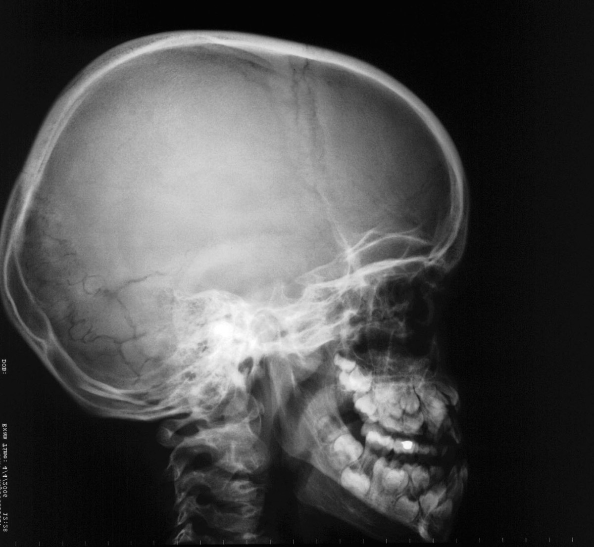 A 13-year-old caucasian boy with cleidocranial dysplasia: a case report ...