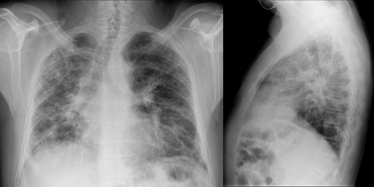 Clinical case: Differential diagnosis of idiopathic pulmonary fibrosis ...
