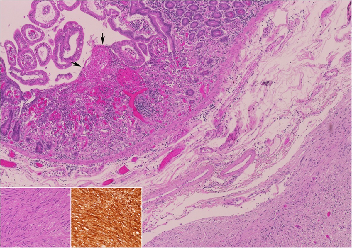 Diagnostic and therapeutic approach to obscure gastrointestinal ...