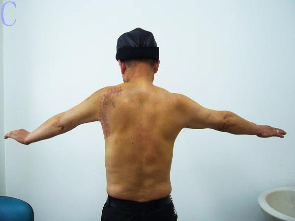 Surgical technique and clinical results for scapular allograft ...