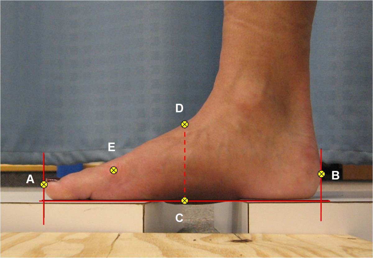 A comparison of foot arch measurement reliability using both digital ...
