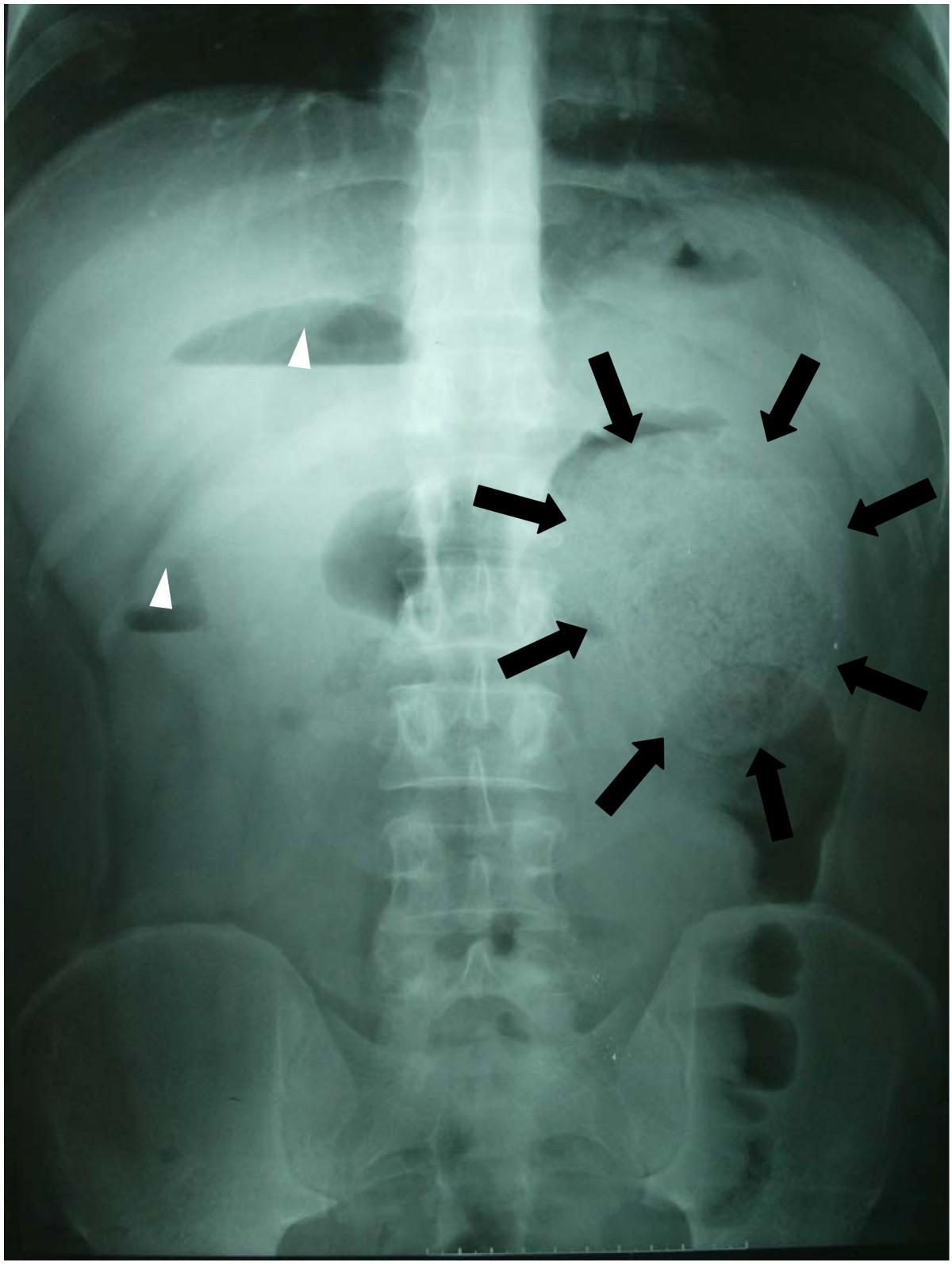 Severe adult ileosigmoid intussusception prolapsing from the rectum: A ...