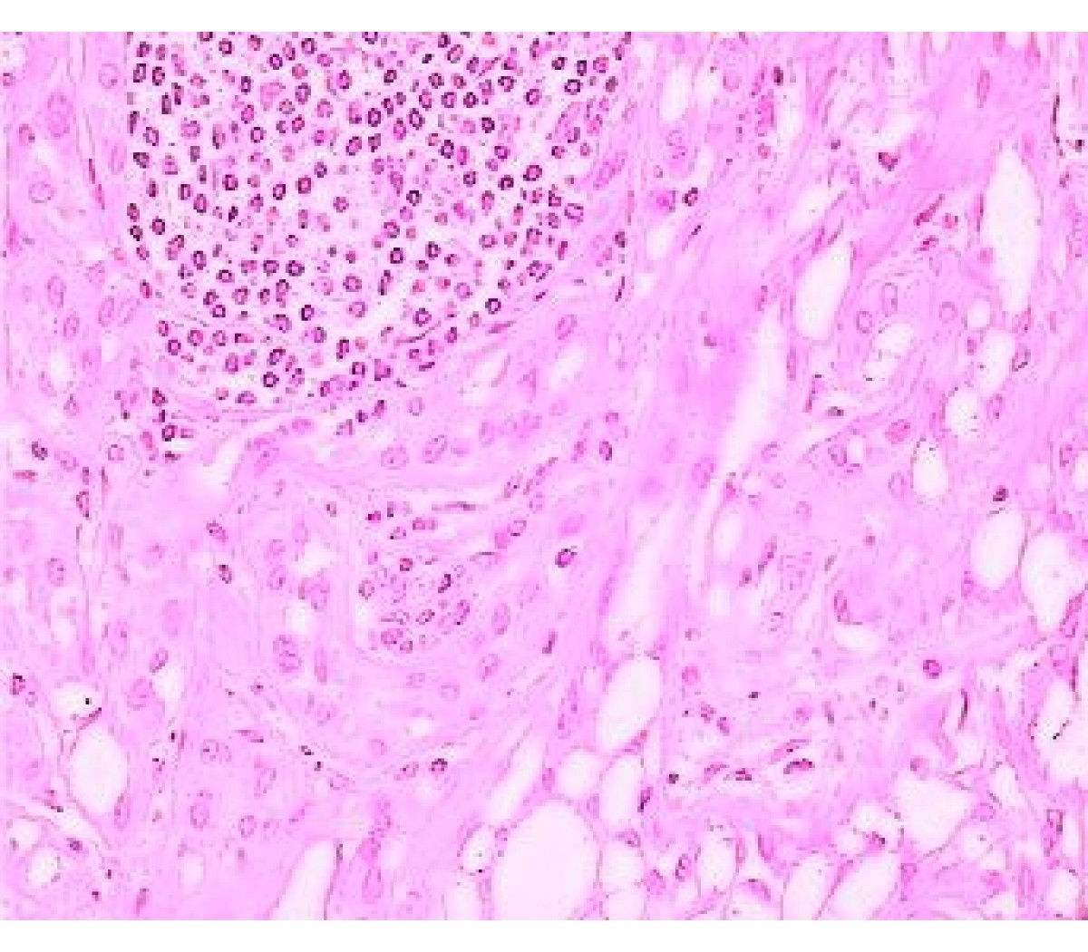 Adenomatoid Tumor Of Epididymidis A Case Report Cases Journal Full