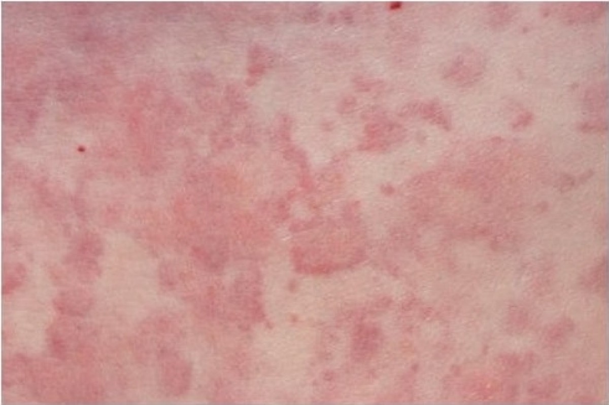 A rare cause of a common symptom, Anakinra is effective in the ...