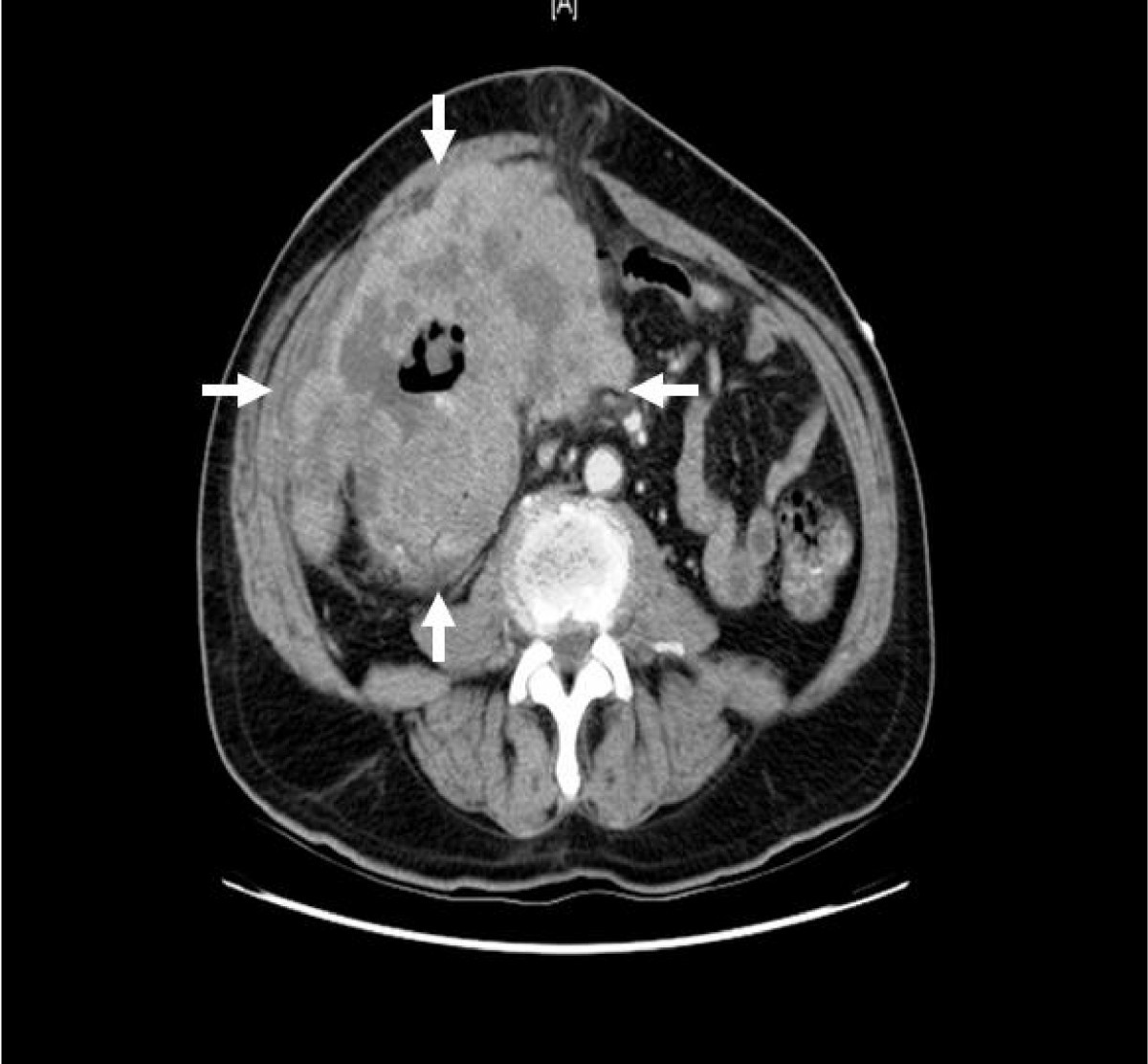 Unusual sized cecal mass presenting without obstruction: a case report ...