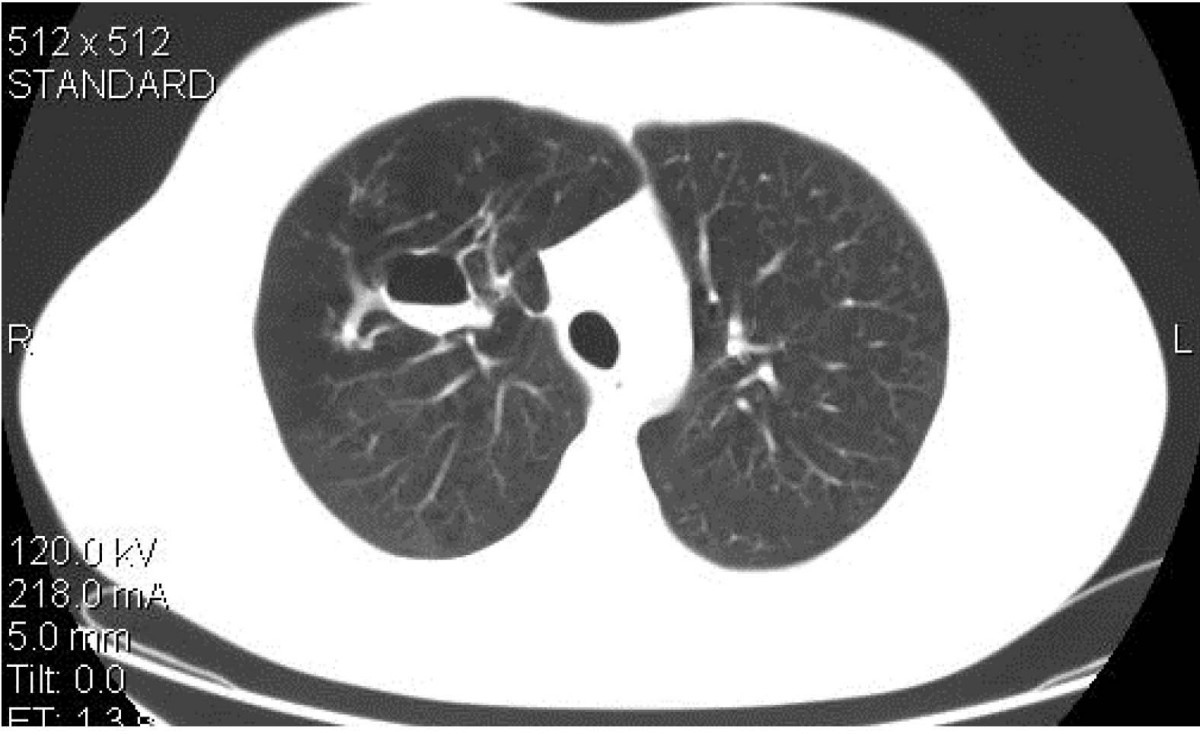Congenital bronchial atresia presenting as a cavitary lesion on chest ...