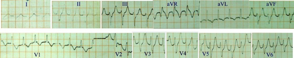 Pyrogen reaction and conversion of sustained ventricular tachycardia to ...