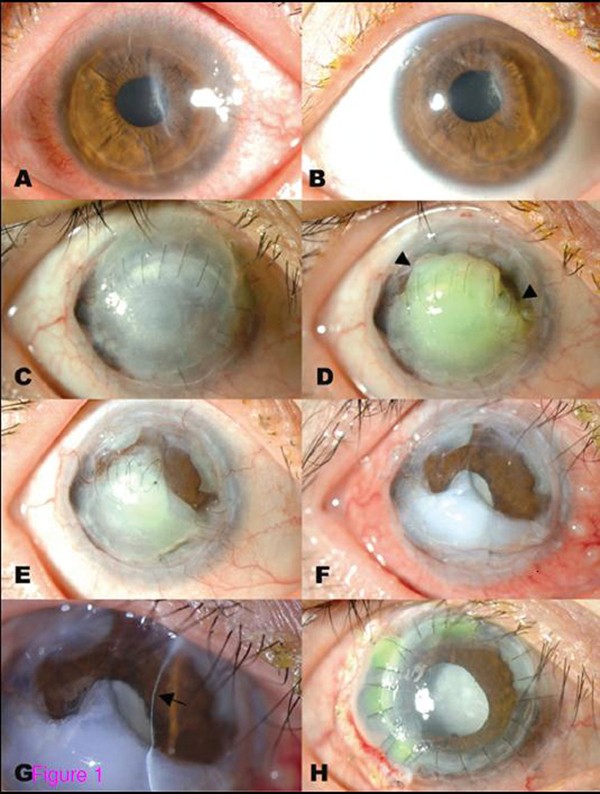 Spontaneous corneal melting during pregnancy: a case report | Cases ...