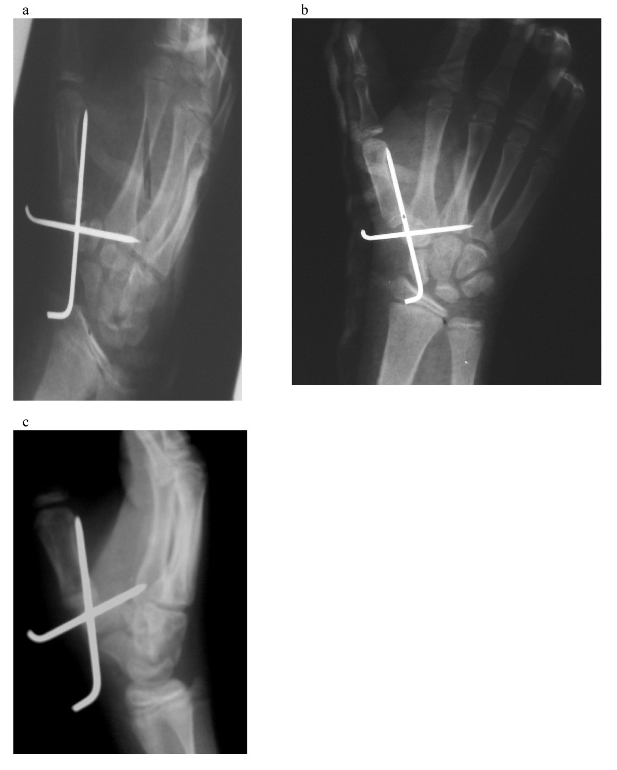 Open complete dislocation of trapezium with a vertically split fracture ...