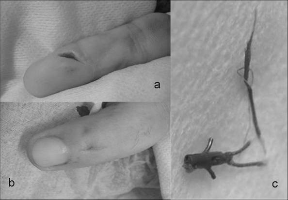 An unusual complication of Mitek suture anchor use in primary treatment ...