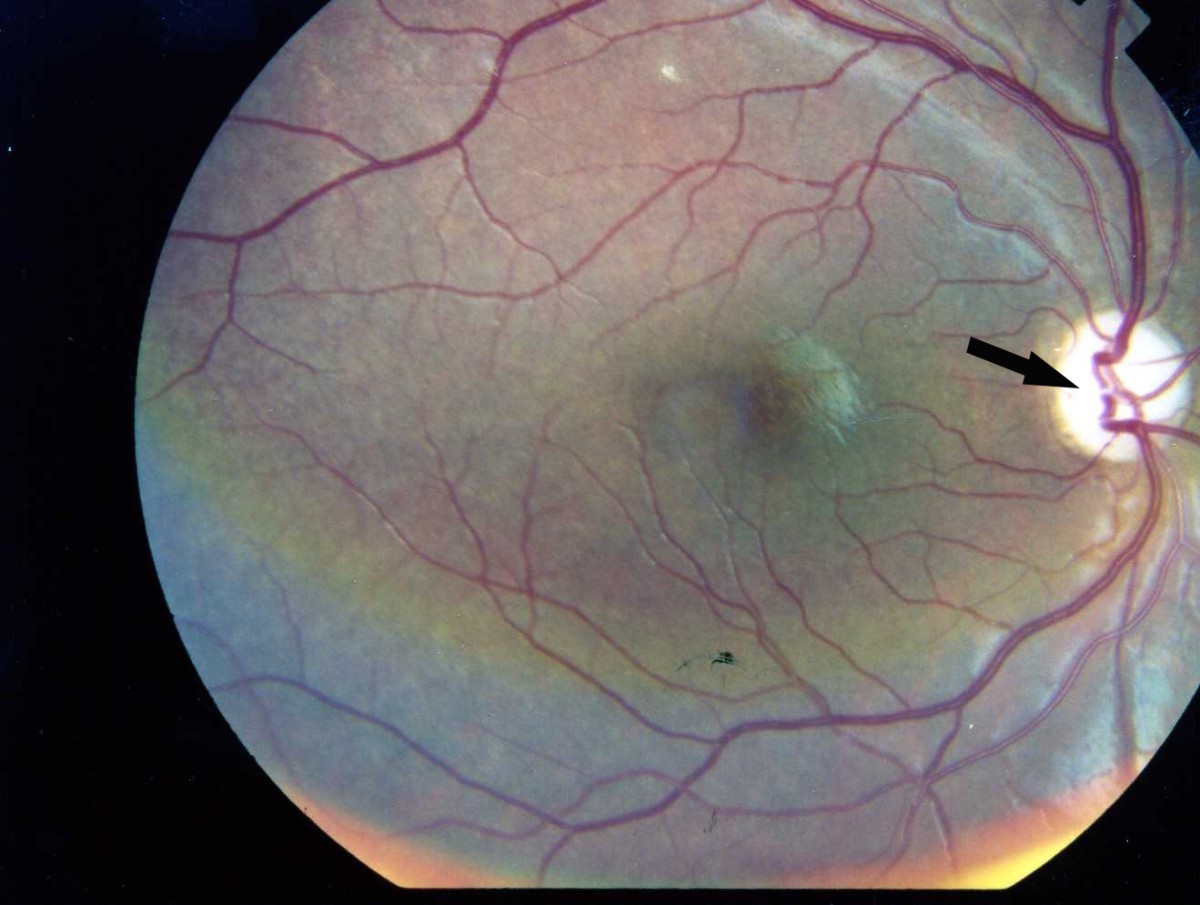 Wolfram Syndrome presenting with optic atrophy and diabetes mellitus ...