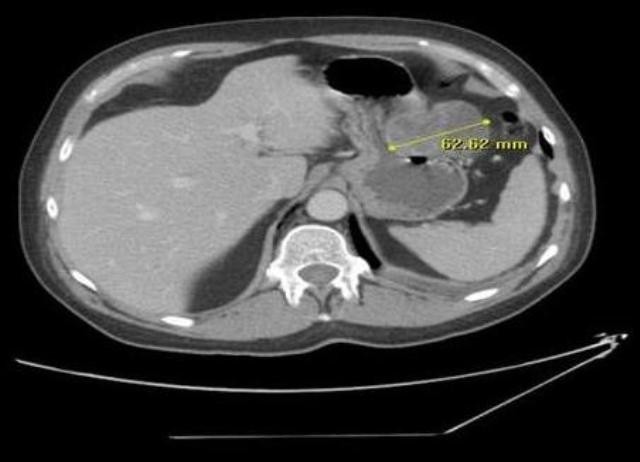 Upper gastrointestinal bleeding due to gastric stromal tumour: a case ...