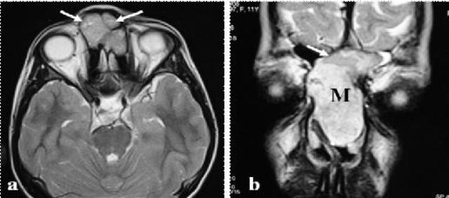 Modified lateral rhinotomy for fronto-ethmoid schwannoma in a child: a ...