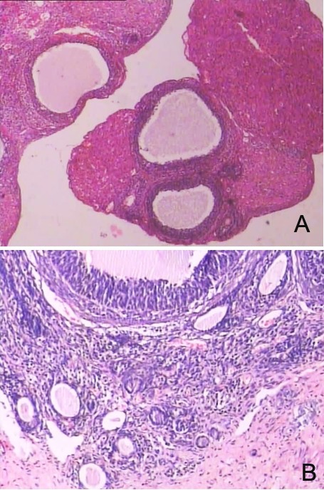 Polycystic ovary syndrome resembling histopathological alterations in ...