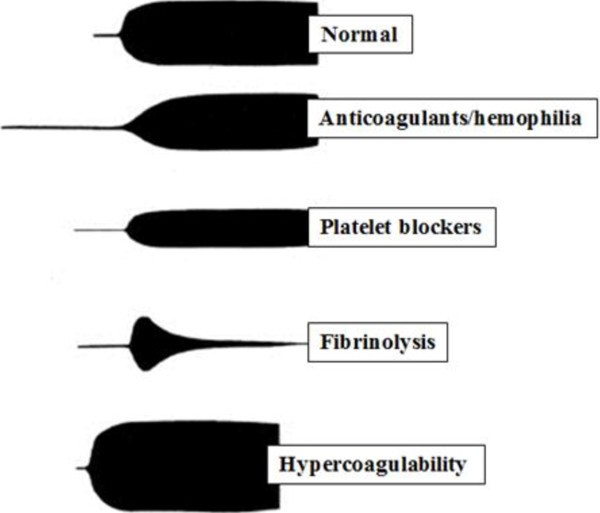 Thrombelastography (TEG®): practical considerations on its clinical use ...