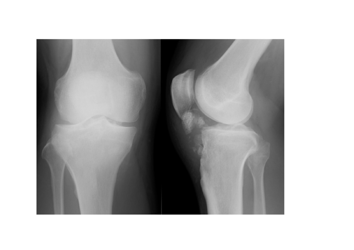 Arthroscopic resection of multiple ossifying tumors in the ...