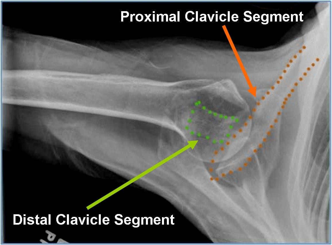 A variant of a type V lateral clavicle fracture involving a posteriorly ...